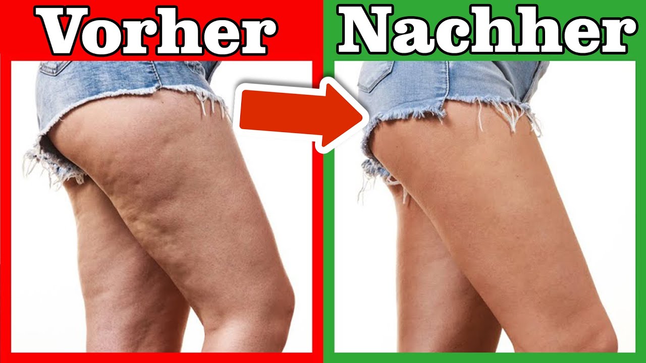 7 Lebensmittel, die deine CELLULITE bekämpfen 💥 (Schnell und einfach) 🤯 - YouTube
