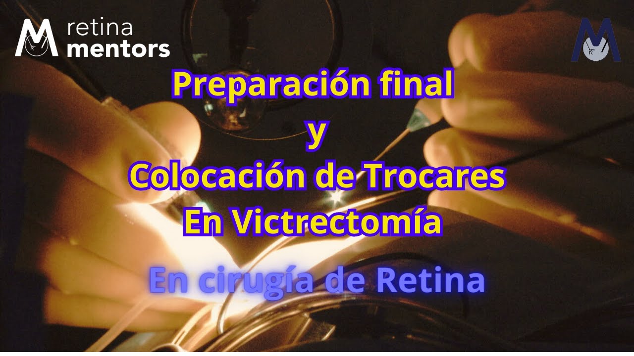 Preparación final y Colocación de Trocares en Vitrectomía - YouTube