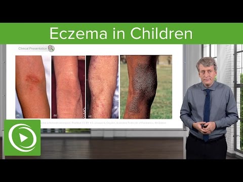Eczema in Children – Pediatrics | Lecturio