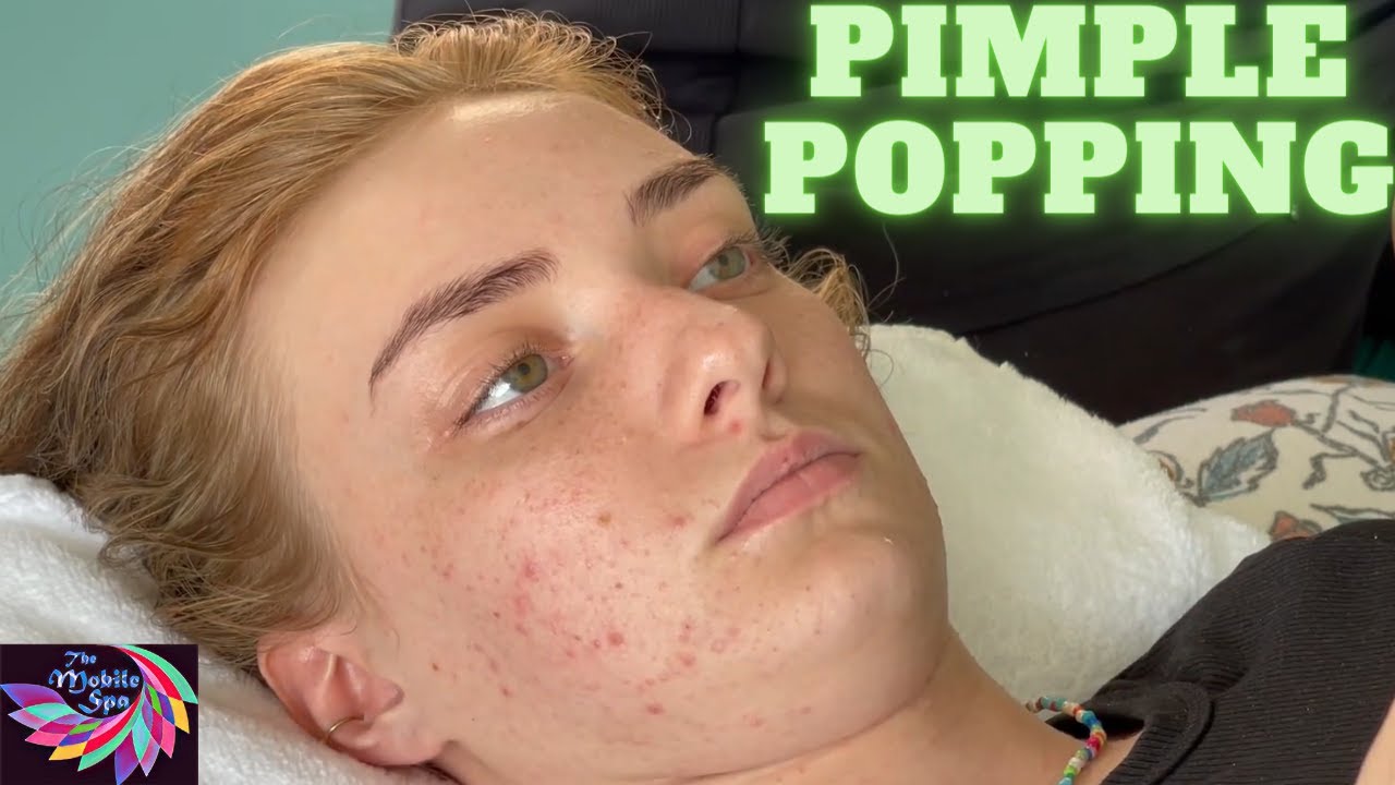 "Satisfying Skincare: Delving into Pimple Popping with the Extractor ...