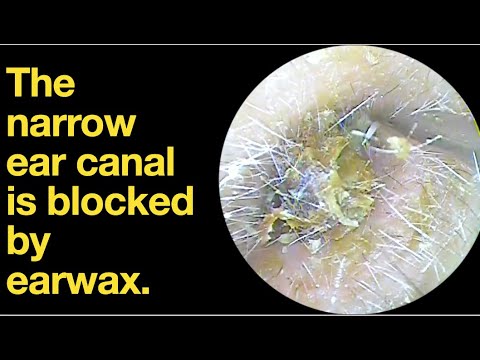 The narrow ear canal is blocked by earwax.|ear wax removal | ear ...