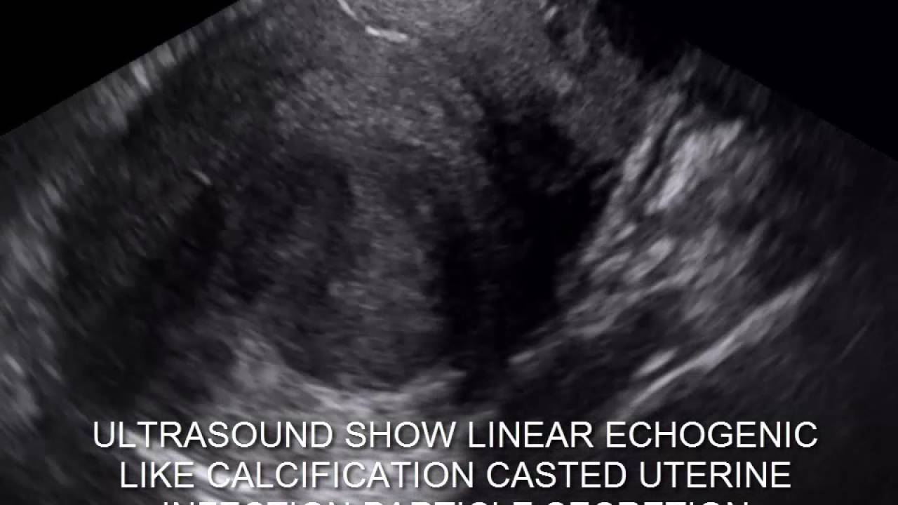 CASE 179 CALCIFIED LIKE CAST UTERINE INFECTION - YouTube