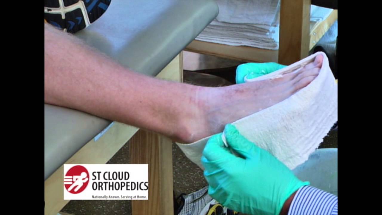 St. Cloud Orthopedics - Casting for Orthotics - YouTube