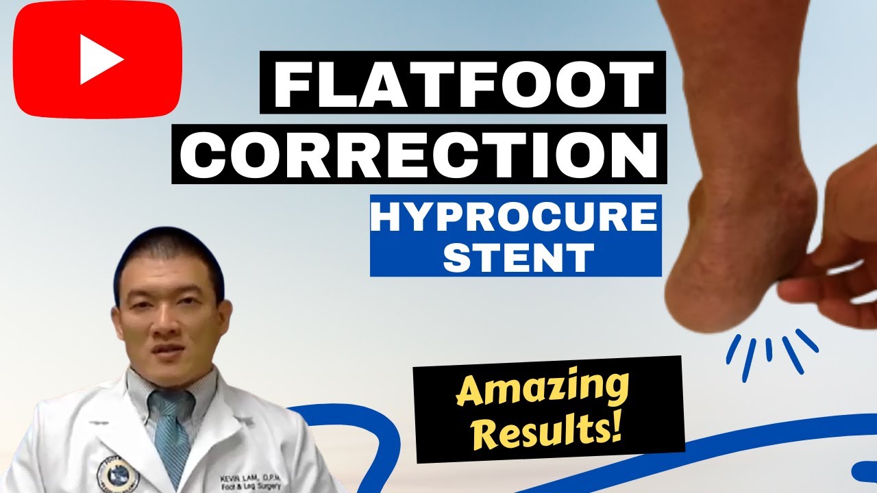 Flat Foot Correction with Hyprocure stent, results amazing | Florida ...