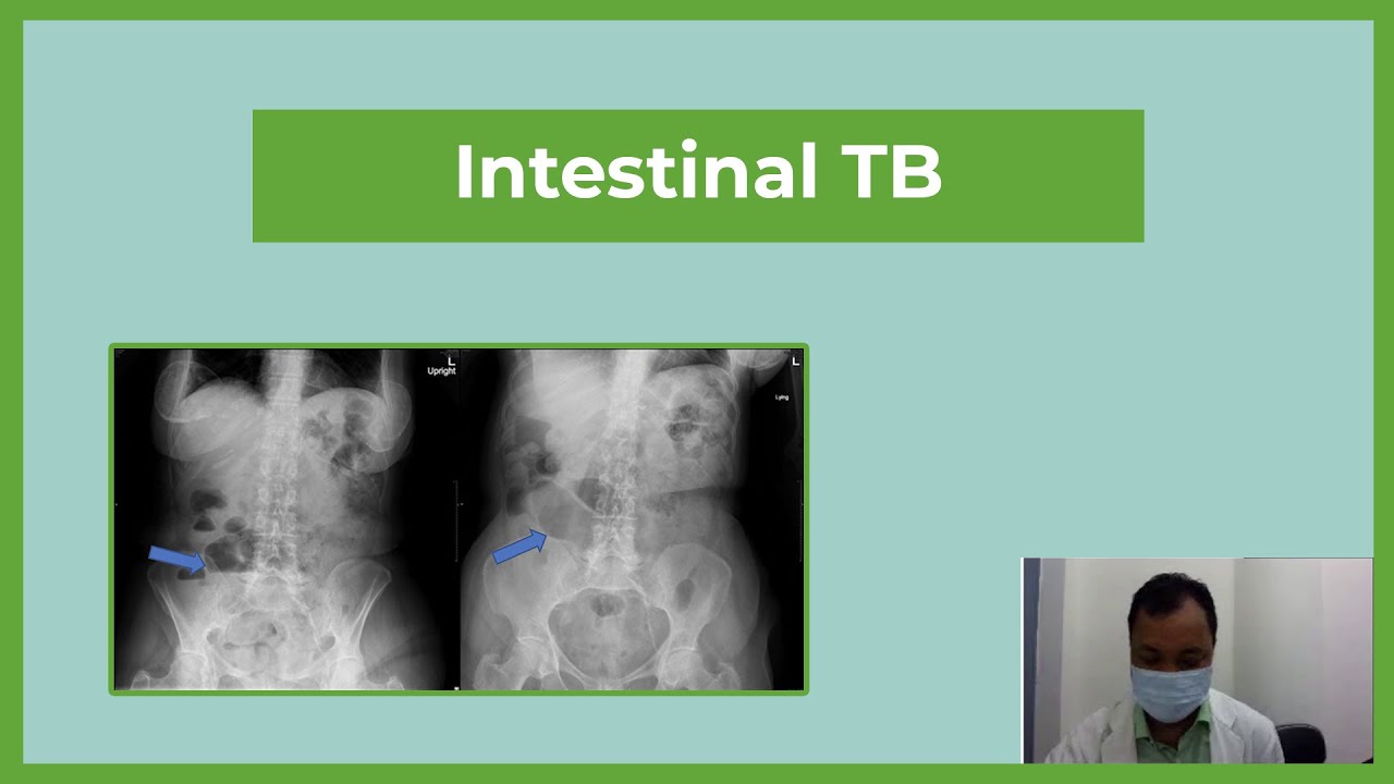 Dr Ranendra Hajong - Intestinal TB | MBBS | General Surgery | NEIGRIHMS ...
