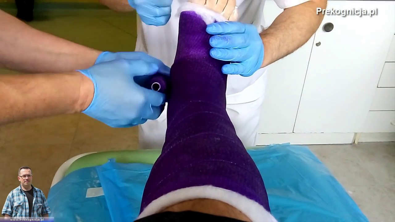 Lekki gips syntetyczny, żywiczny - zerwane ścięgno Achillesa (wideo ...