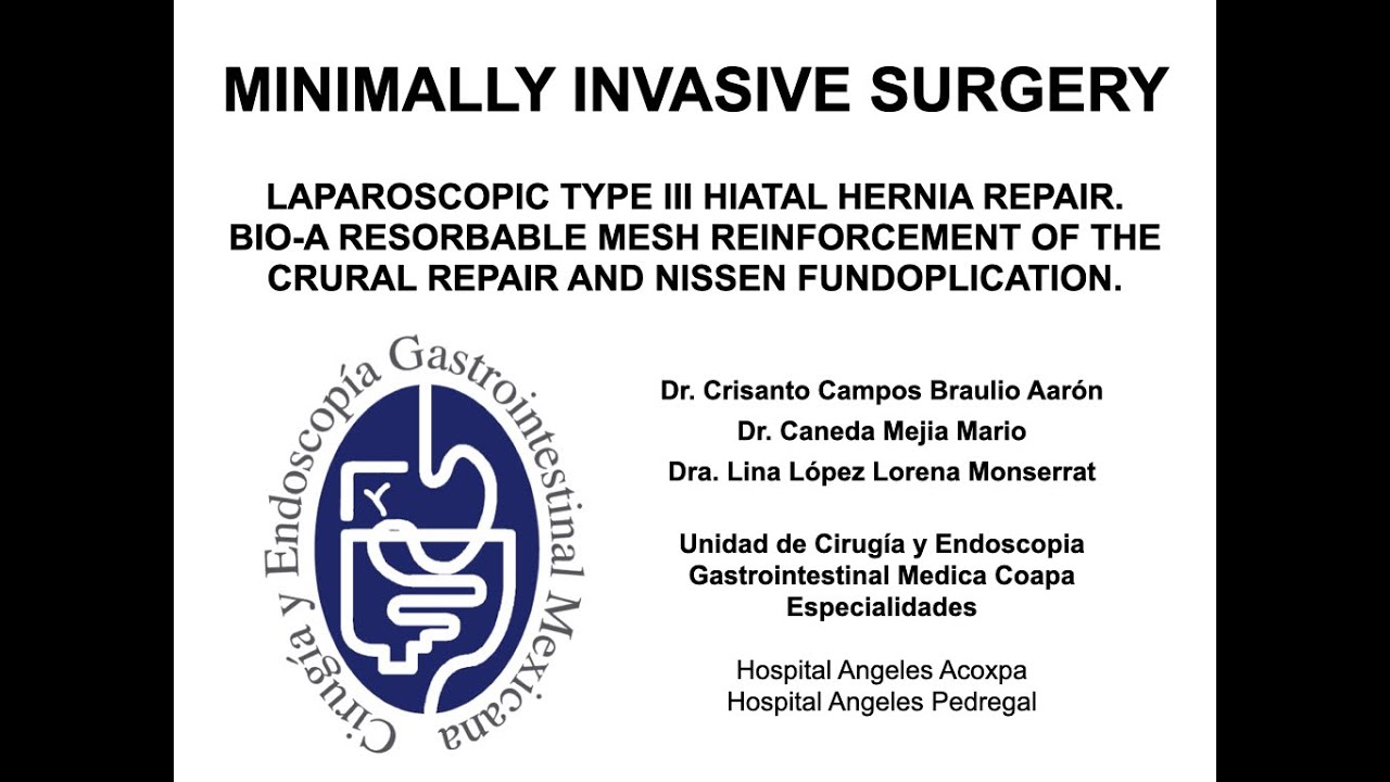 Laparoscopic Type III Hiatal Hernia Repair. - YouTube