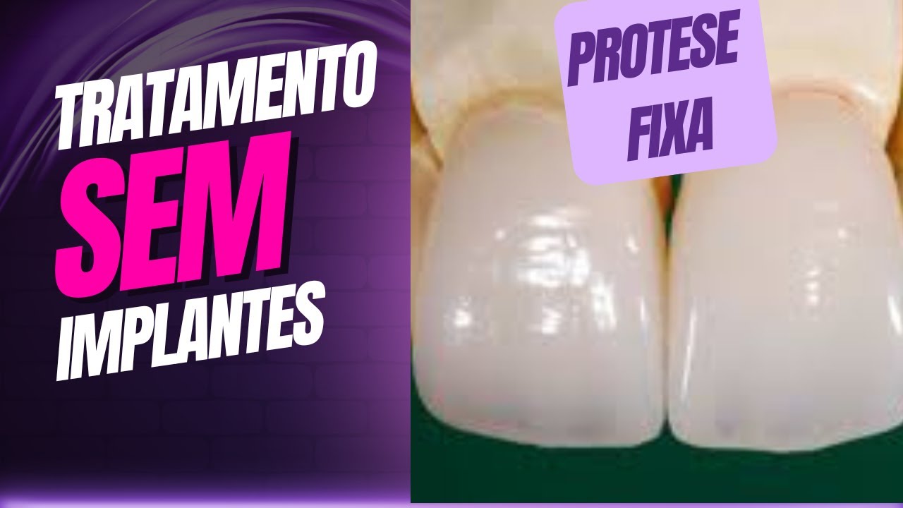 TRATAMENTOS SEM IMPLANTE DENTÁRIO - PROTESE FIXA PARCIAL (PPF) - YouTube