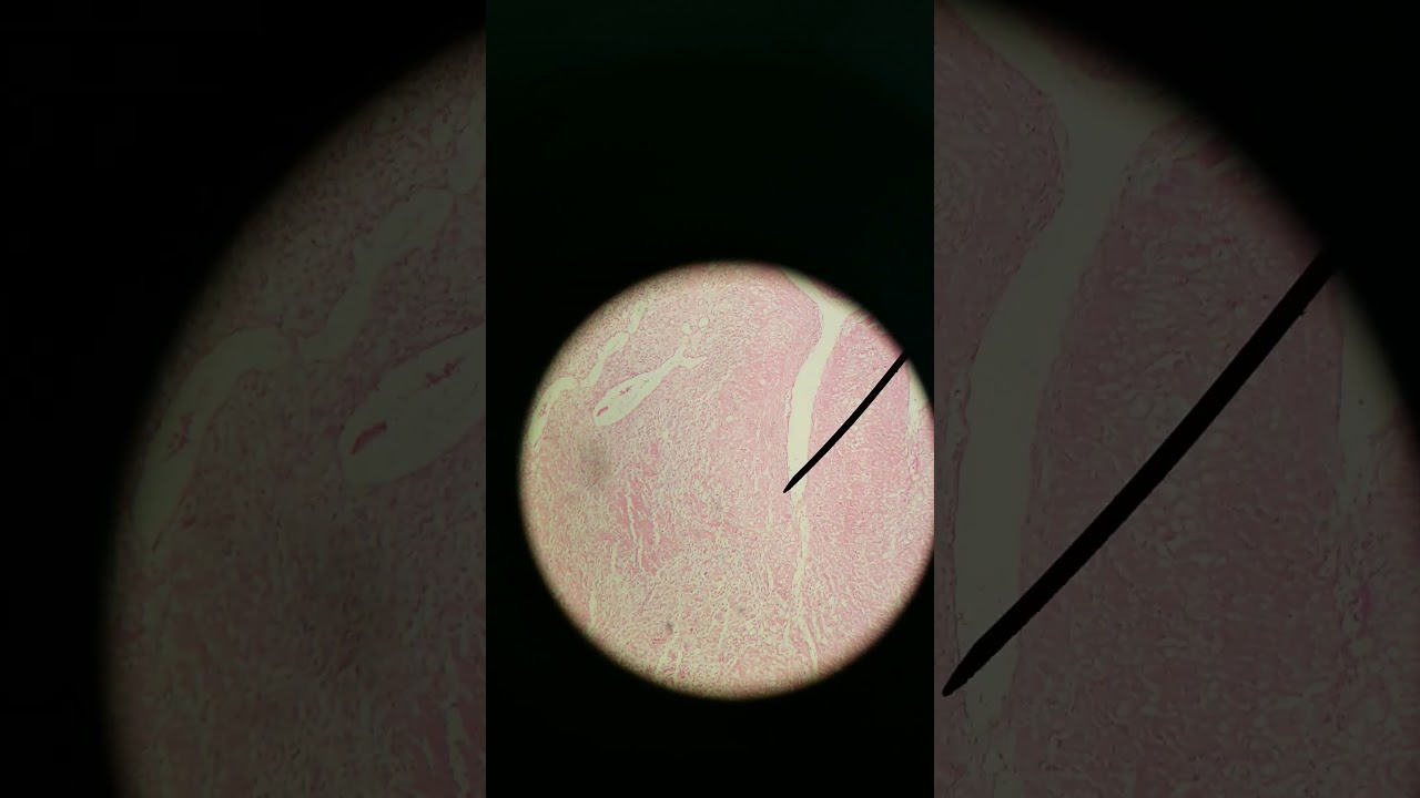 Cardiac muscle intercalated discs and myocardial infarction histology ...