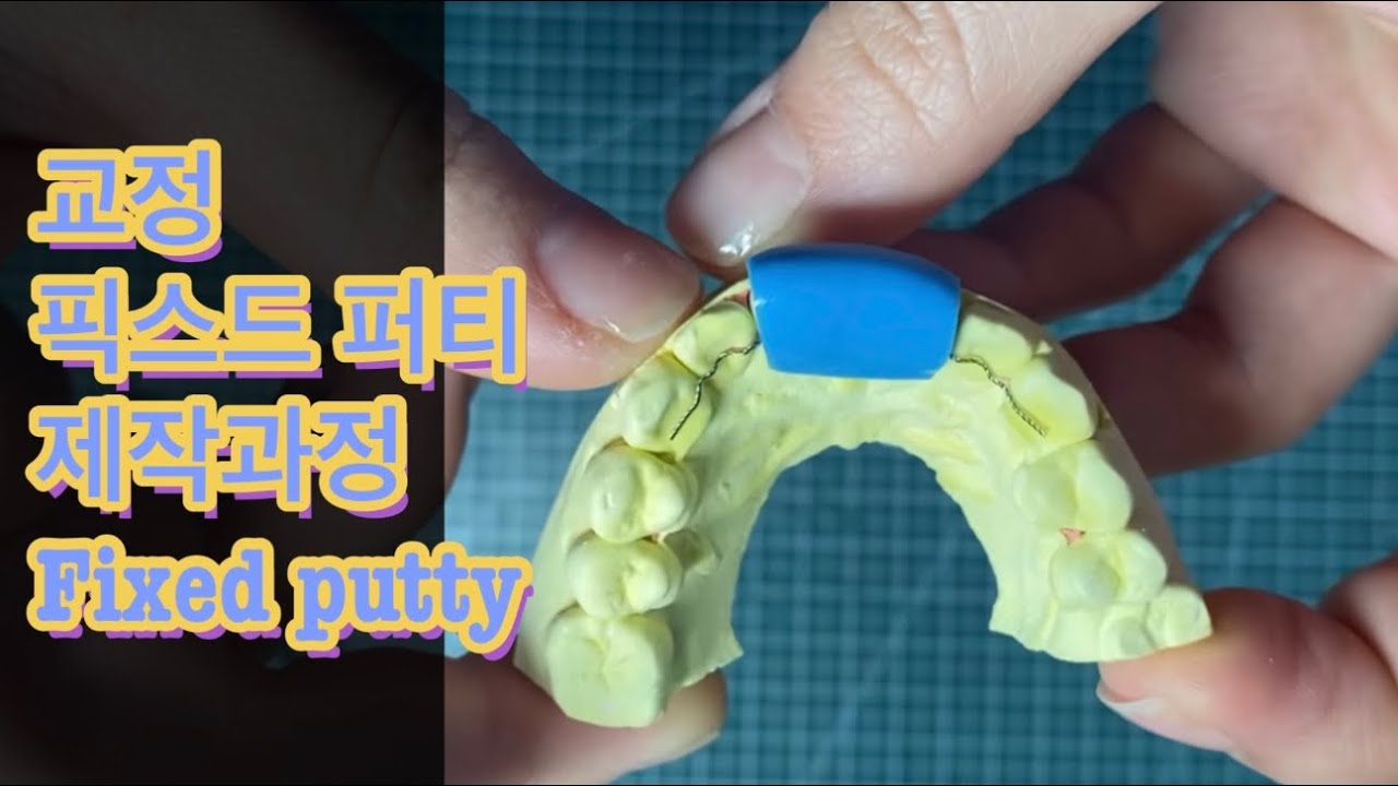 [교정] 픽스드 퍼티 제작과정 / Ortho Fixed retainer putty - YouTube