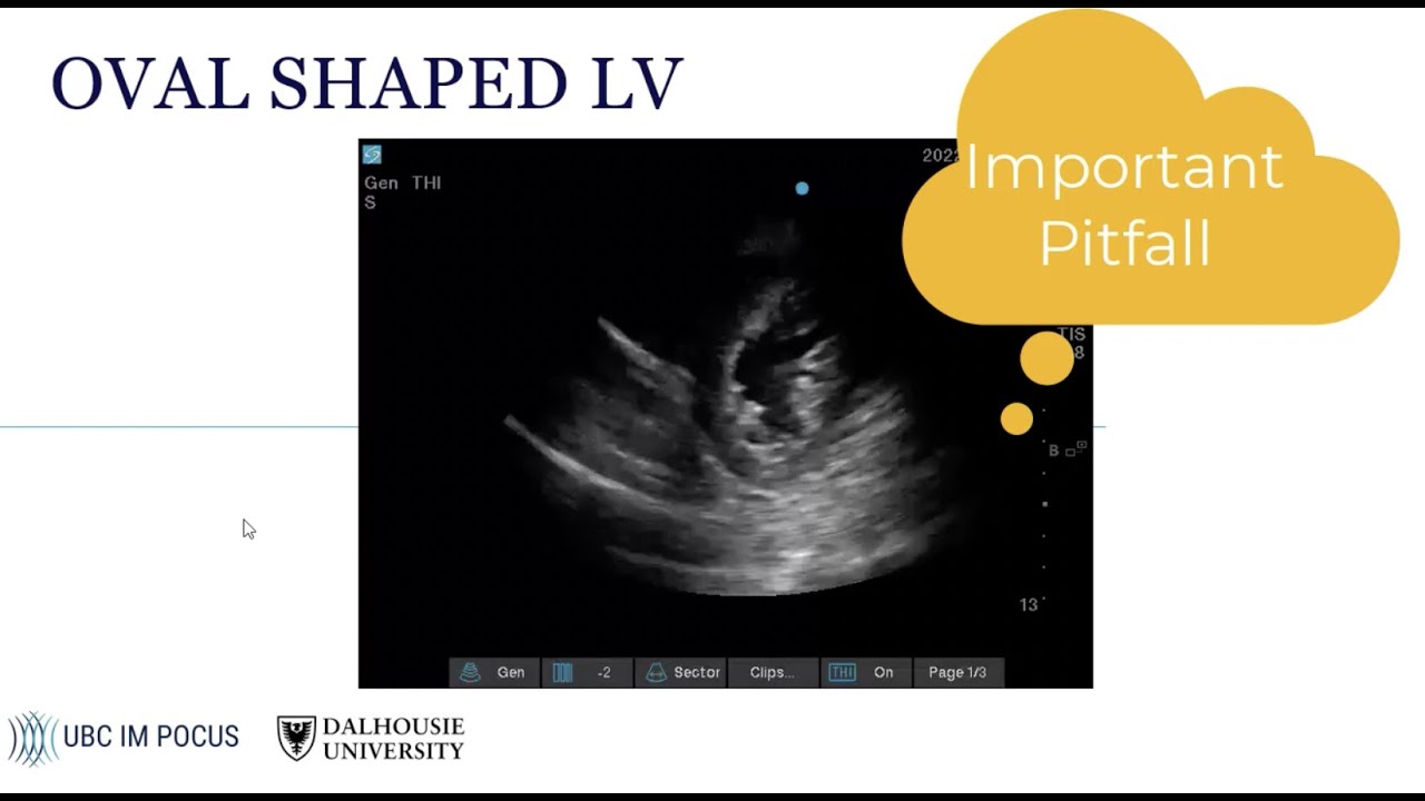Basic cardiac POCUS: image acquisition - YouTube