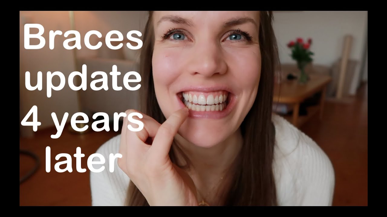 Braces Update 4 Years Later! - YouTube