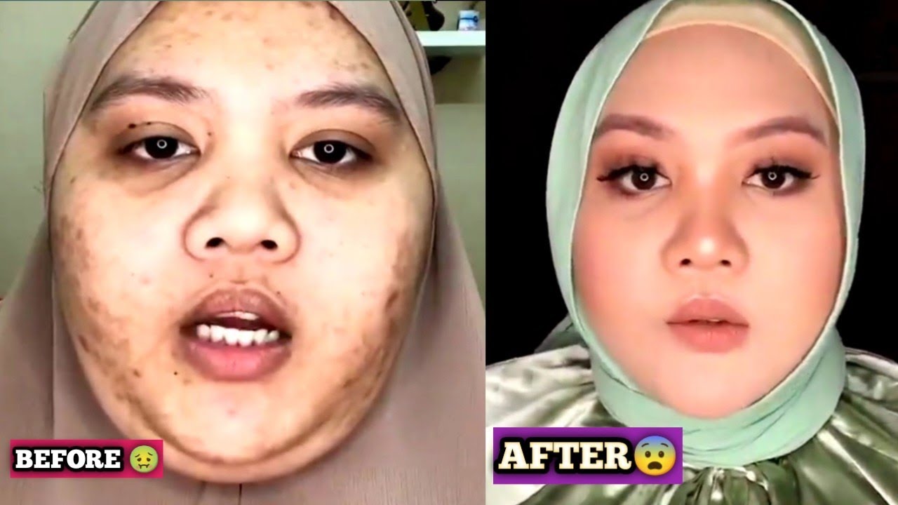Face Transformation || Dark Spots on Face Removal Dark Spots After ...