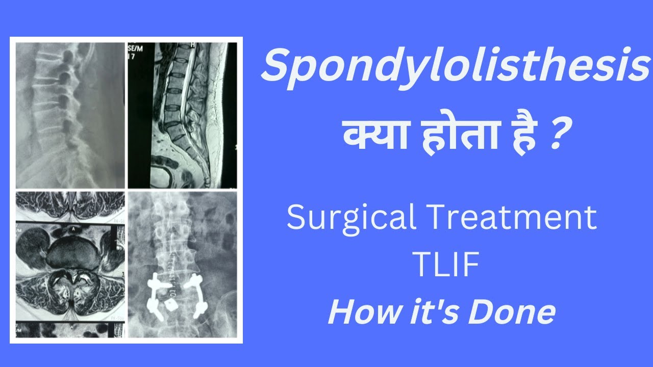 TLIF - Transforaminal Lumbar Interbody fusion for Lumbar ...