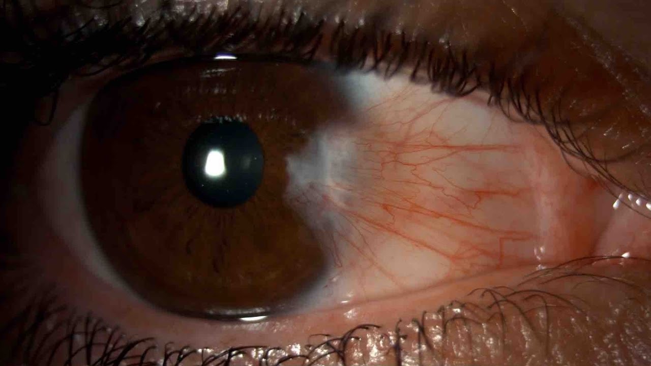 Ever Heard of Pterygium? @mohamedawwad82@SimpleNursing ...