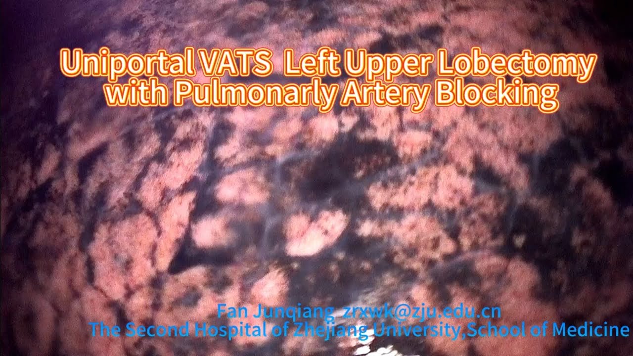 Uniportal VATS Left Upper Lobectomy With Pulmonary Artery Blocking - YouTube