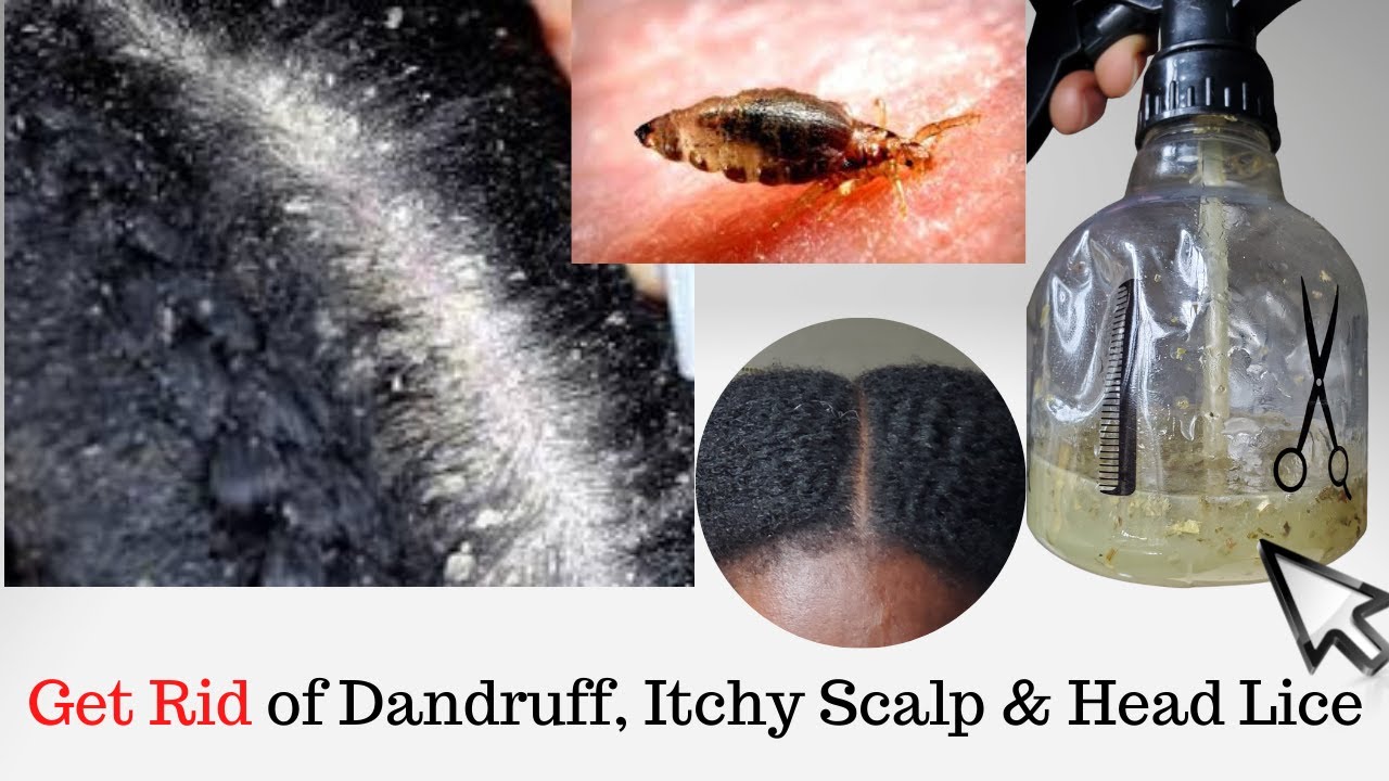 Itchy Scalp Lice