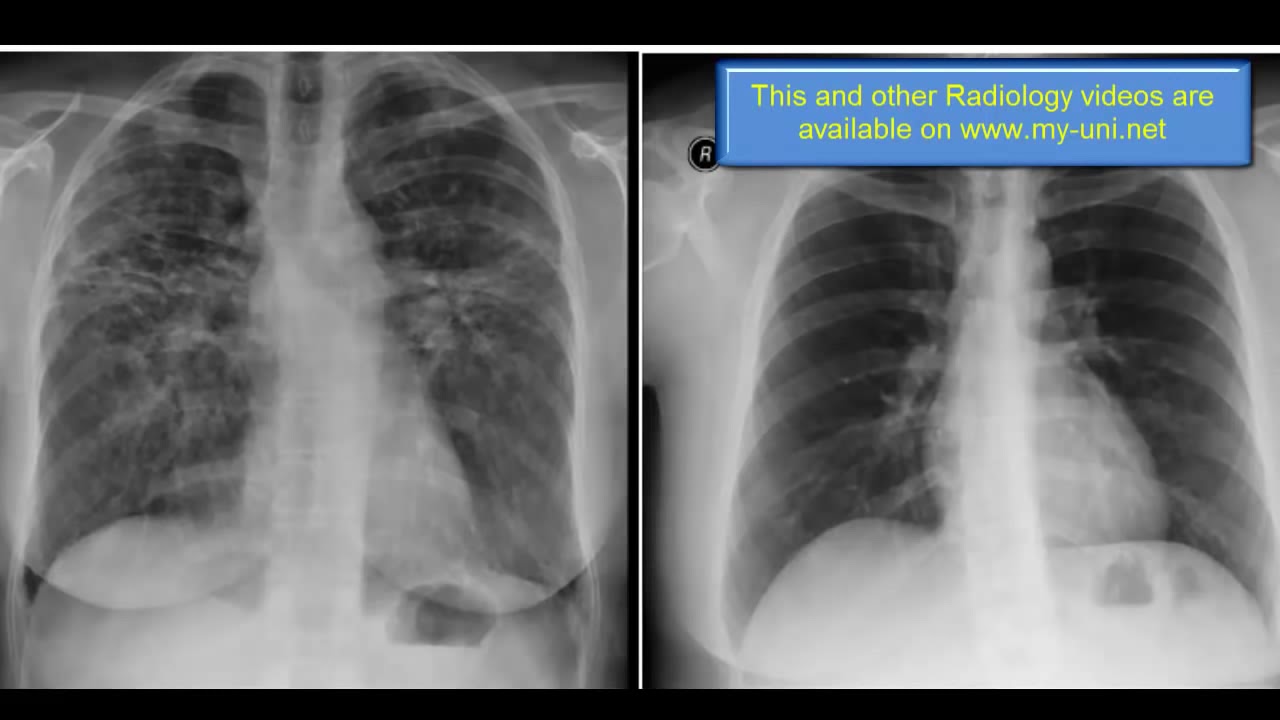 Chest Xray : ILD Fibrosis, Traction bronchiectasis, Sarcoidosis ( by ...