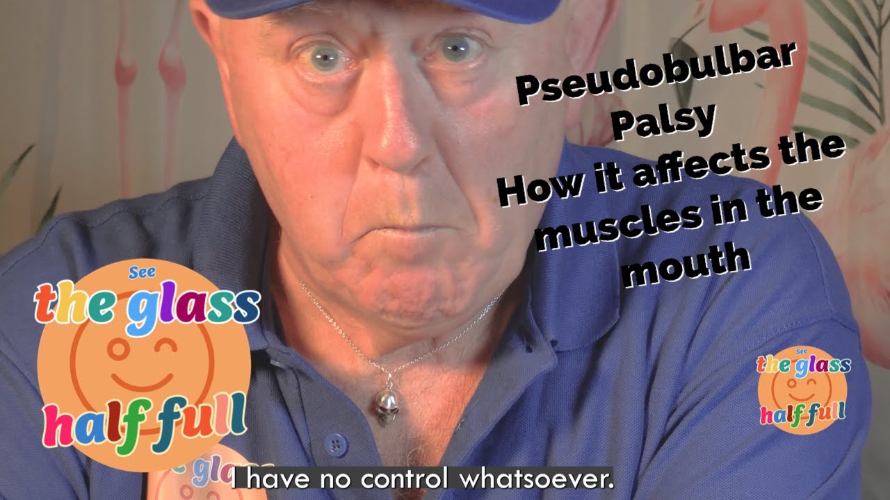 Dysarthria. PP, PLS. A form of MND. How it affects me - YouTube