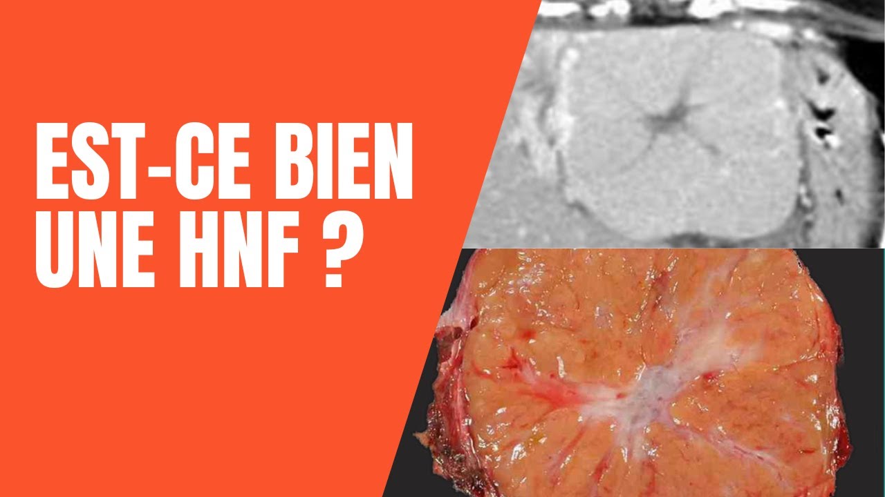 Est-ce bien une HNF (hyperplasie nodulaire focale) - Cours médecine ...