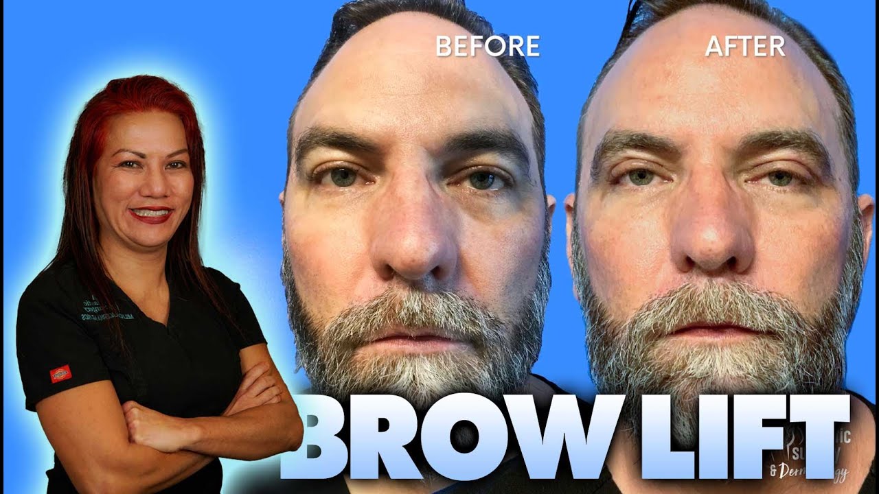 Male Brow Lift - Age 49 - YouTube