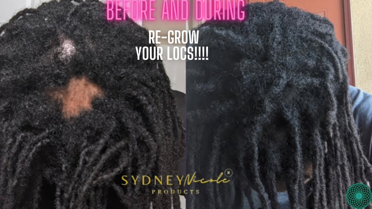 How He Regrew His Thinning Locs and Bald Spots Using Sydney Nicole ...