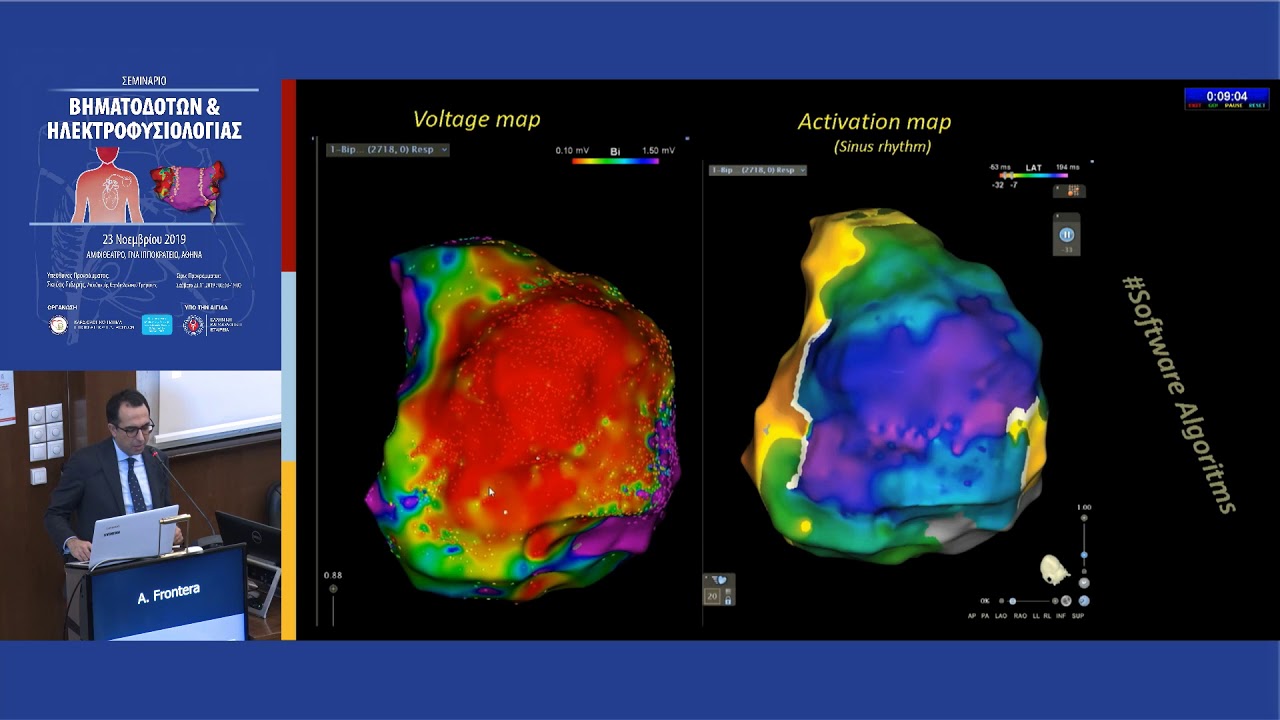 A. Frontera | Substrate mapping in the setting of VT ablation. Past ...