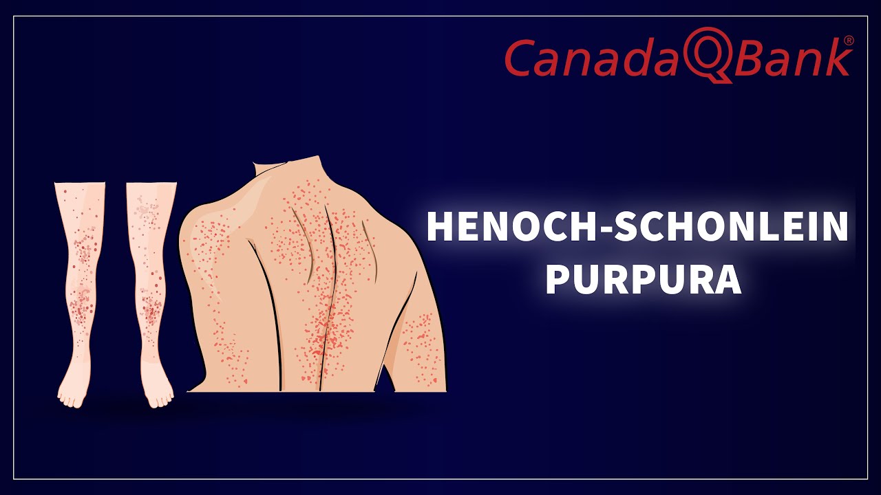 Henoch-Schönlein Purpura (HSP): Rash, Diagnosis & Management ...