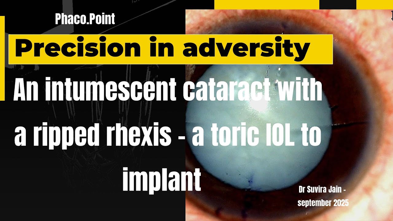 " Precision In Adversity" - An Intumescent cataract with a Ripped ...