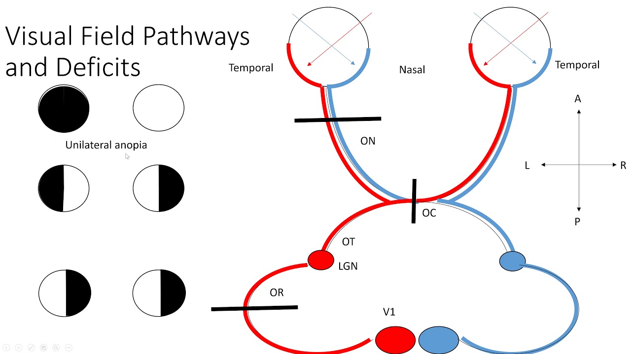 Visual Field Pathways and Deficits - YouTube