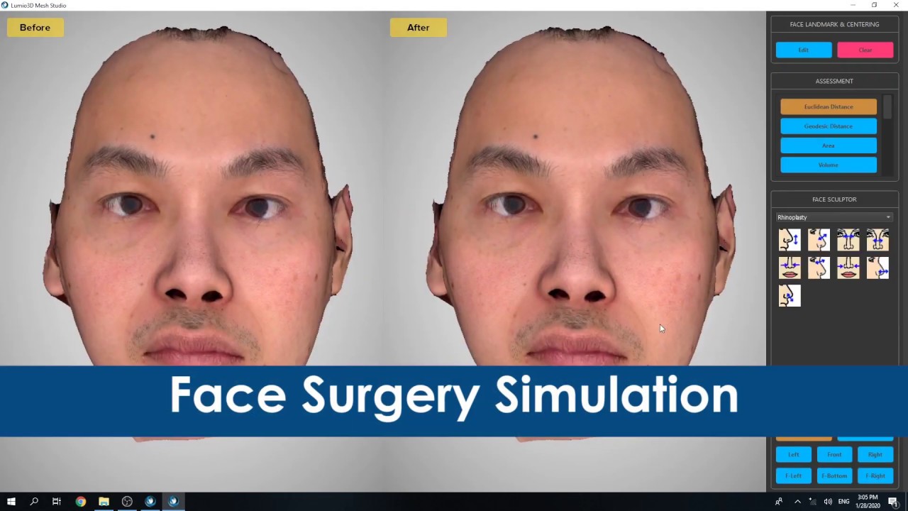 Rapid High Fidelity 3D Face Scanning System and 3D Face Surgery ...