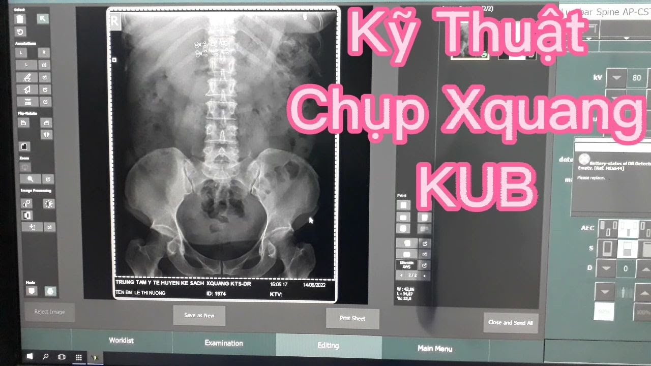 Bài 15/ Kỹ Thuật Chụp Xquang KUB - YouTube