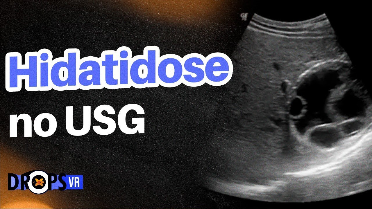 HIDATIDOSE - RECONHECENDO NO USG I VOCÊ RADIOLOGISTA - YouTube