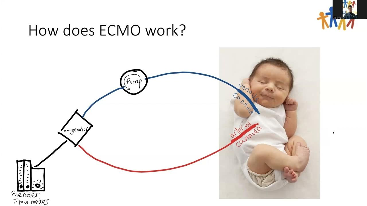 ECMO 101- What is ECMO? - YouTube