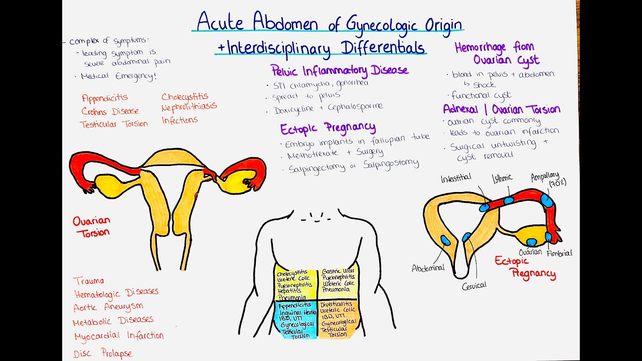 Acute Abdomen of Gynecological and Non-Gynecological Origin - YouTube