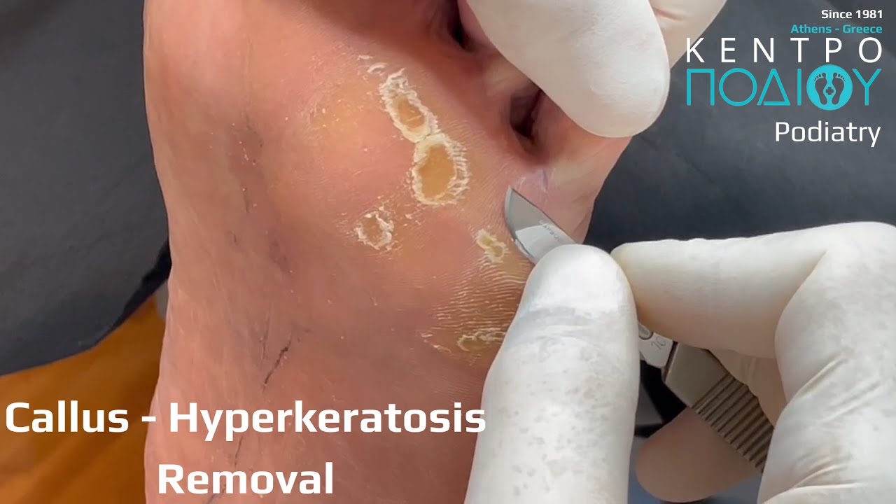 Callus & hyperkeratosis removal|Αφαίρεση Κάλων|Κέντρο Ποδιού Podiatry ...