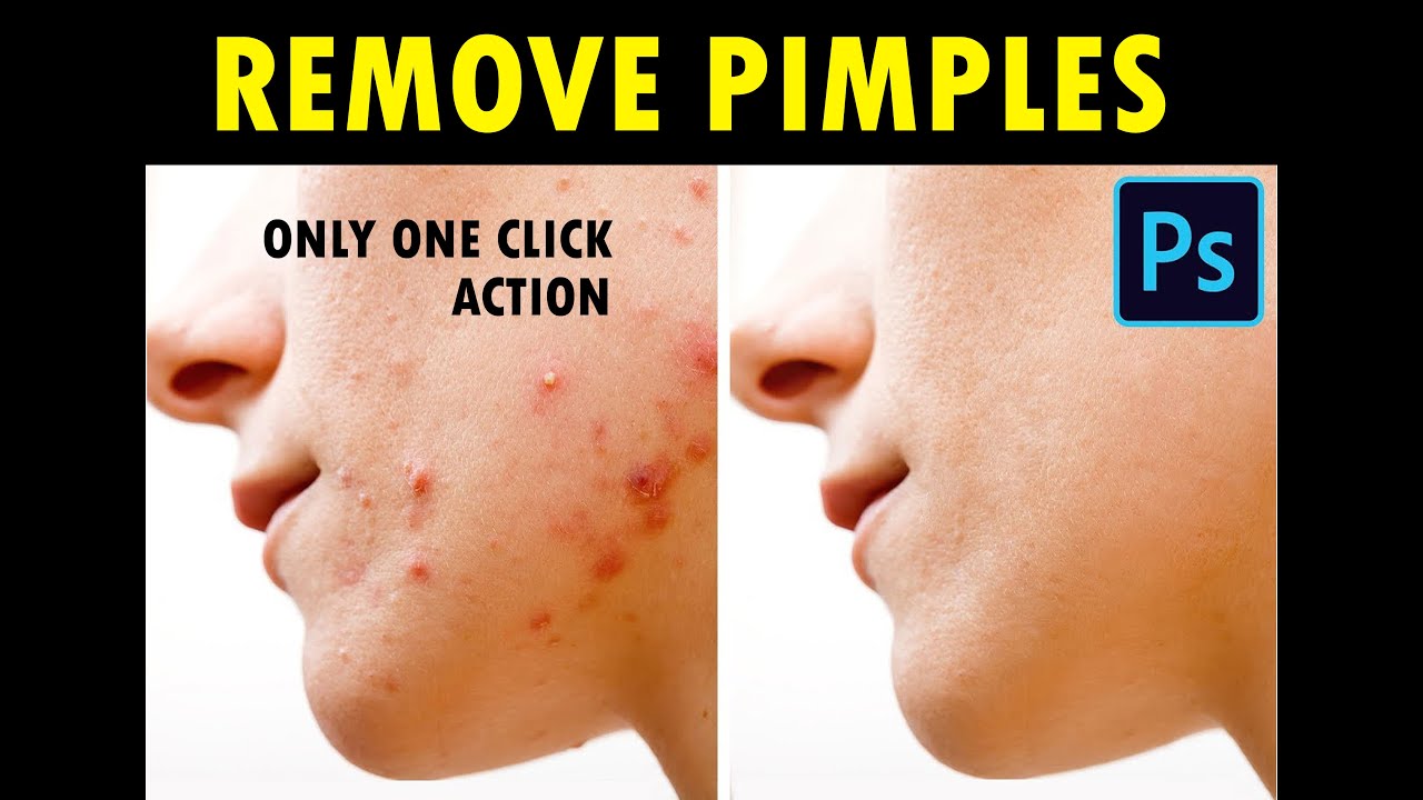 Remove Pimples How To Remove Acne In Photoshop How To Remove Acne Pimples In Photoshop 7 0 YouTube remove-pimples-how-to-remove-acne-in-photoshop-how-to-remove-acne-pimples-in-photoshop-7-0-youtube