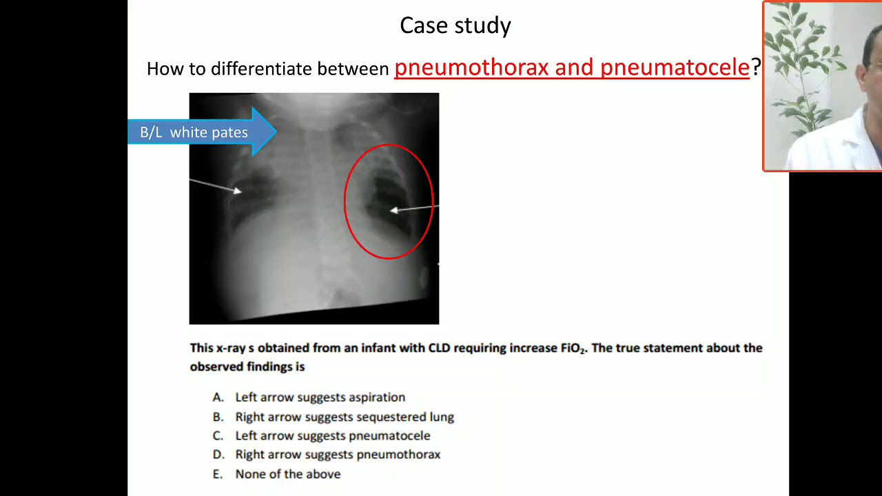Case 41 how to differentiate between pneumothorax and pneumatocele ...