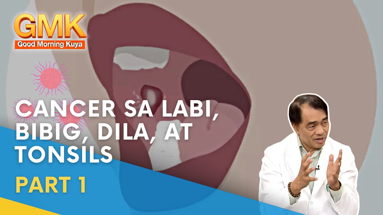 Cancer sa Labi, Bibig, Dila, at Tonsils (Part 1) | Usapang ...