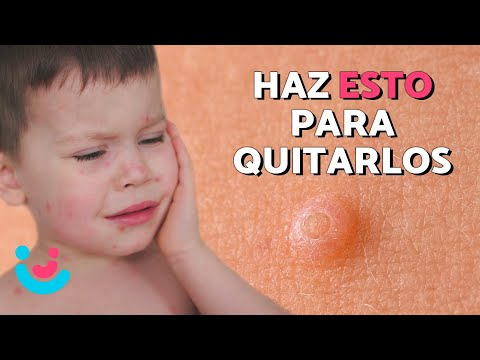 🔎 ¿Cómo ELIMINAR los MOLUSCOS CONTAGIOSOS en la PIEL de los NIÑOS? 👩‍⚕️ (Tratamiento y CAUSAS)