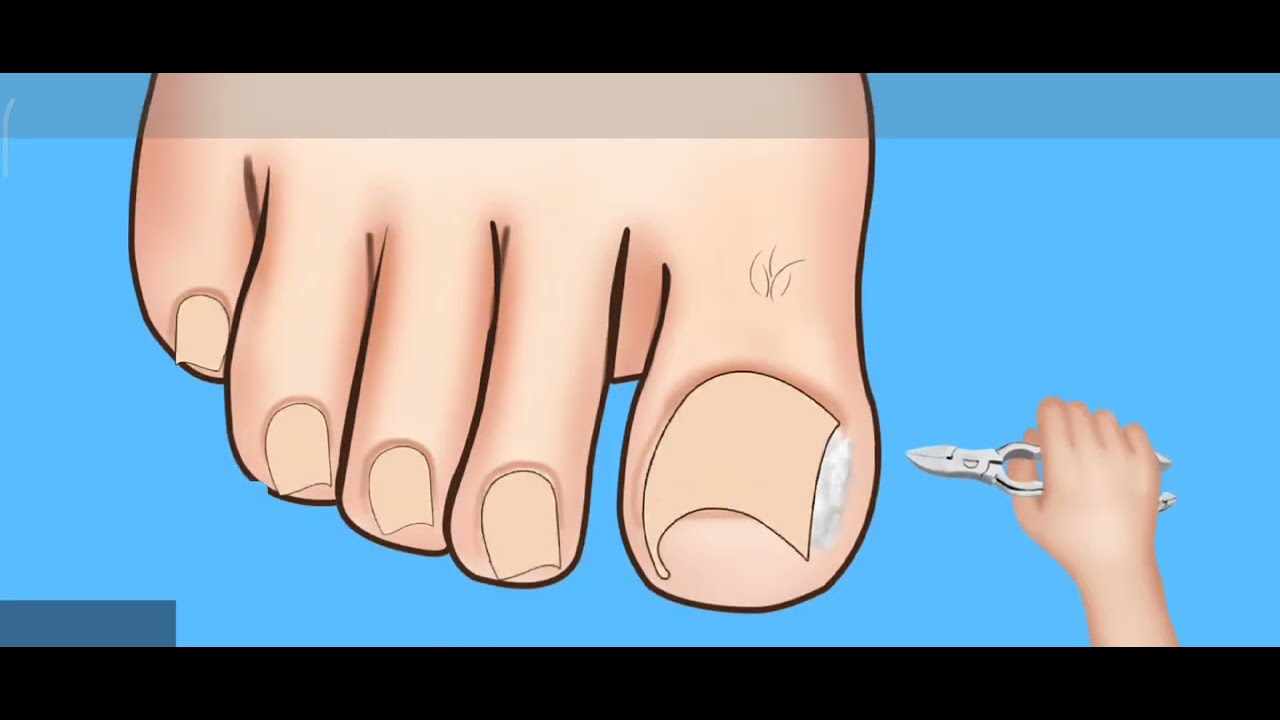 ASMR Ingrown Toenail Removal Treatment Animation~Strong Satisfaction ...