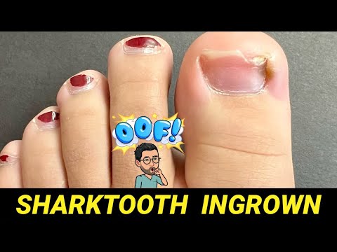 SUPER PAINFUL SHARKTOOTH INGROWN TOENAIL ** WAIT UNTIL YOU SEE THE SIZE ...
