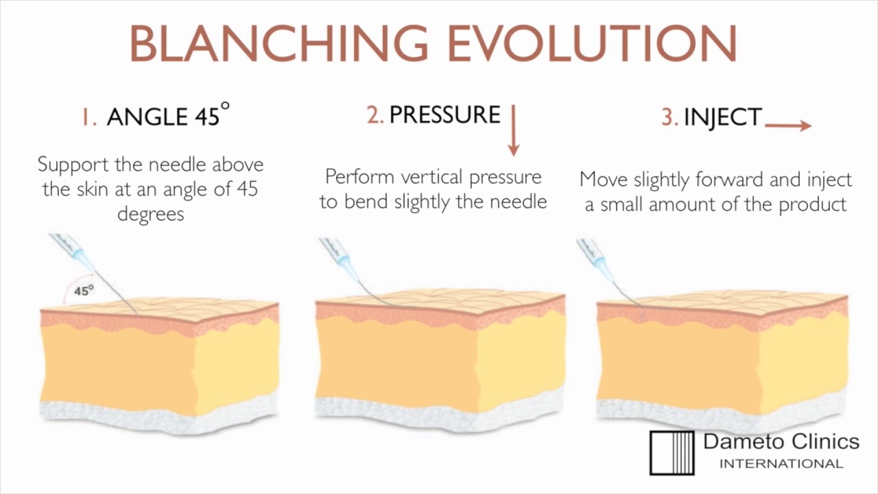 Dr. Gabriel Siquier "blanching evolution" technique at Dameto Clinics ...