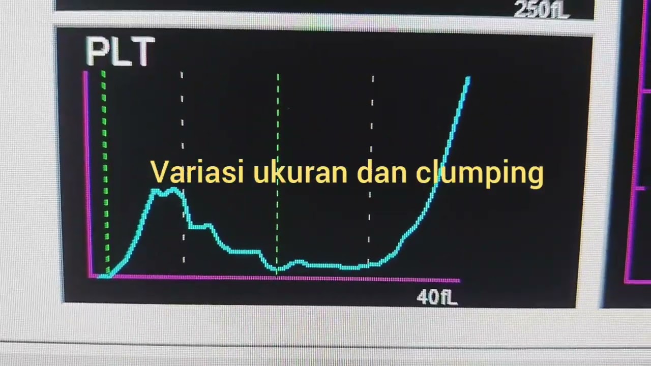 Gambaran Darah Rutin Demam Berdarah Dengue (DBD) | Baca Hasil ...