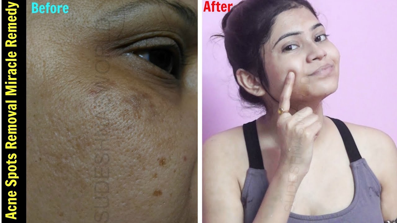 Miracle Acne Scars Removal Treatment | Remove DARK SPOTS , BLACK SPOTS ...