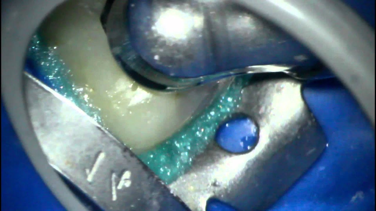 ENDODONTIC RETREATMENT WITH R ENDO UNDER LABOMED MICROSCOPE - YouTube