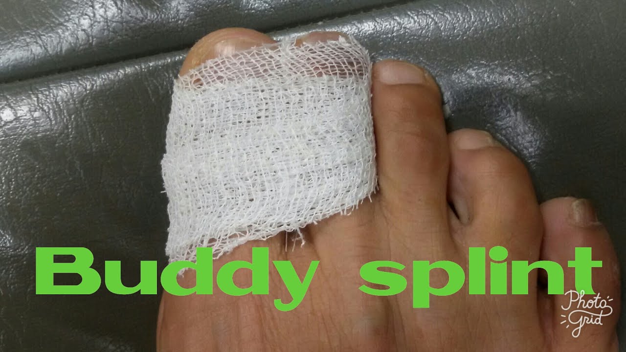 Buddy splint by RAKE Krittanai - YouTube