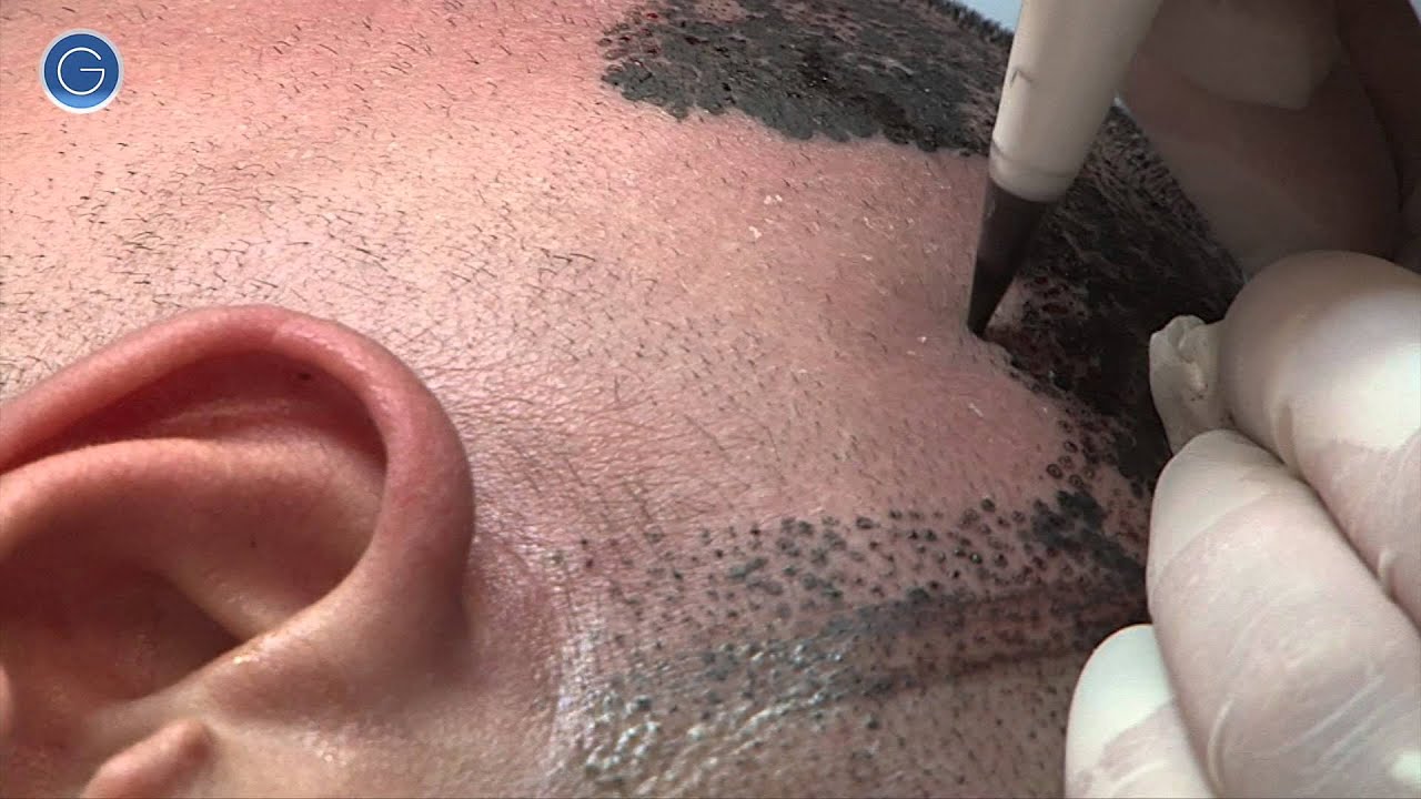 Micropigmentación Capilar - Masterclass Goldeneye - FEB 2015 - YouTube