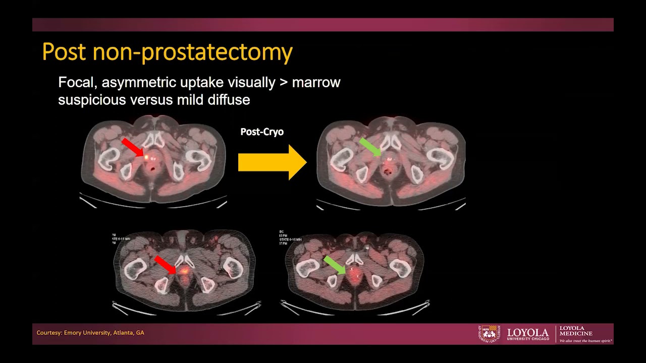 CT and PET CT in prostate cancer - YouTube