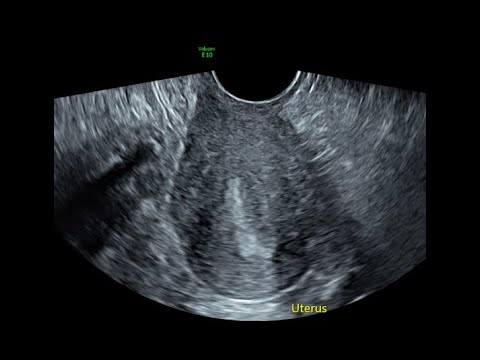 hysteroscopy in a patient with previous Manchester repair - YouTube